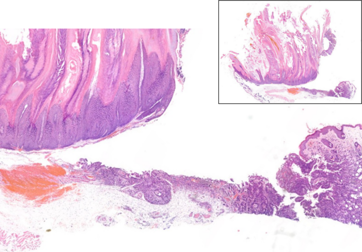 Squamous papilloma with squamous cell carcinoma in a gerbil ...