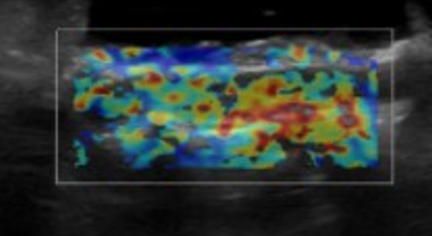 Diagnostic imaging for acute thoracolumbar intervertebral disc ...